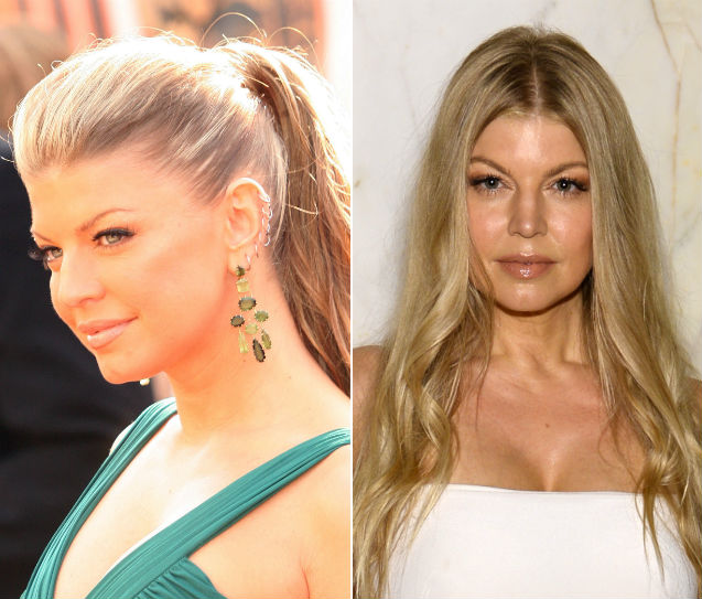 Famosas com botox: compare o antes e depois de quem supostamente ...