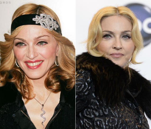 Famosas com botox: compare o antes e depois de quem supostamente ...