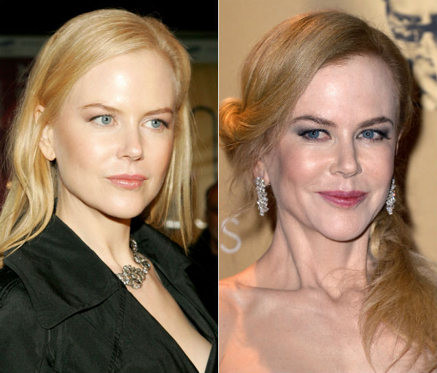 Famosas com botox: compare o antes e depois de quem supostamente ...